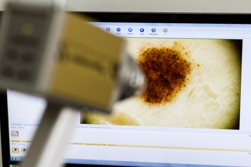 Incidența cancer cutanat