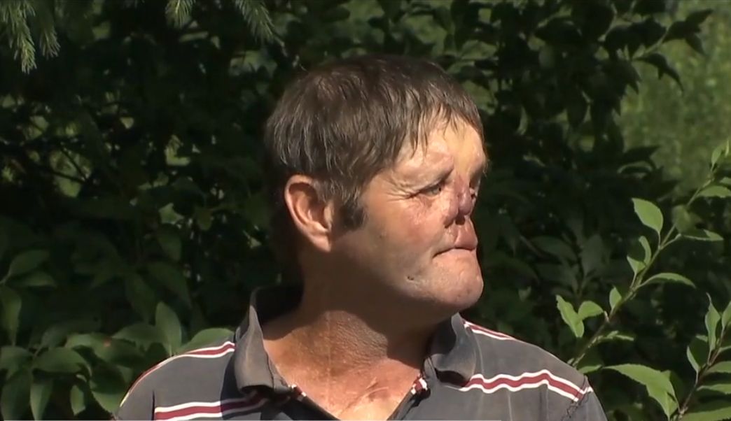 Mărturia cutremurătoare a bărbatului desfigurat de urs și operat de 80 ...