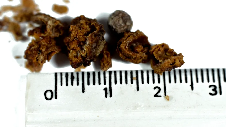 Cum să elimini pietrele la rinichi FĂRĂ PASTILE și fără să te doară