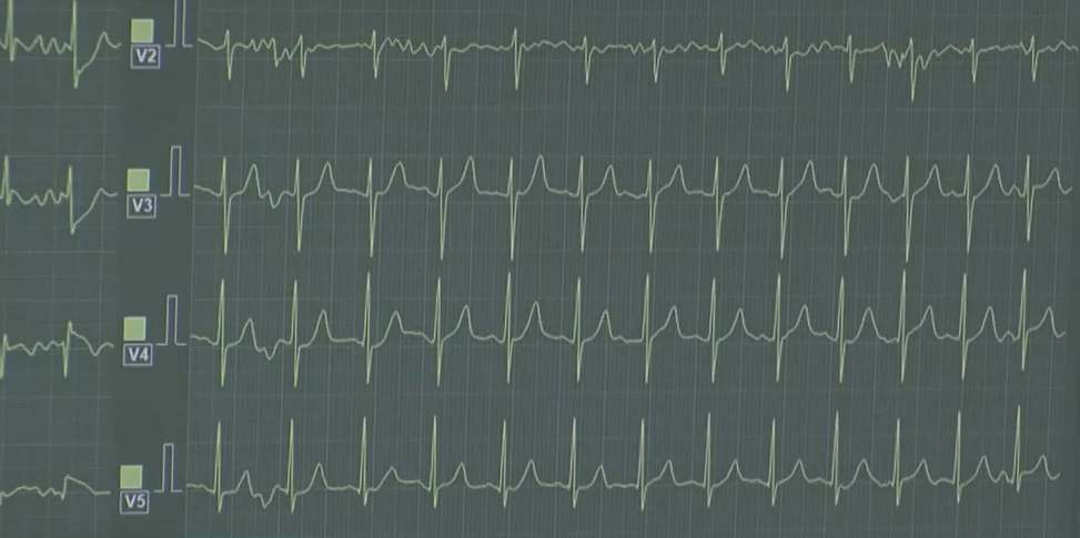 Cum ar putea fi ajutați cardiacii sau hipertensivii, cu ajutorul ...